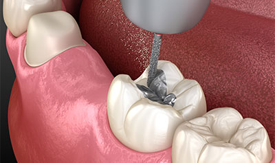 Remoção segura de amálgama - Centro Conscientia