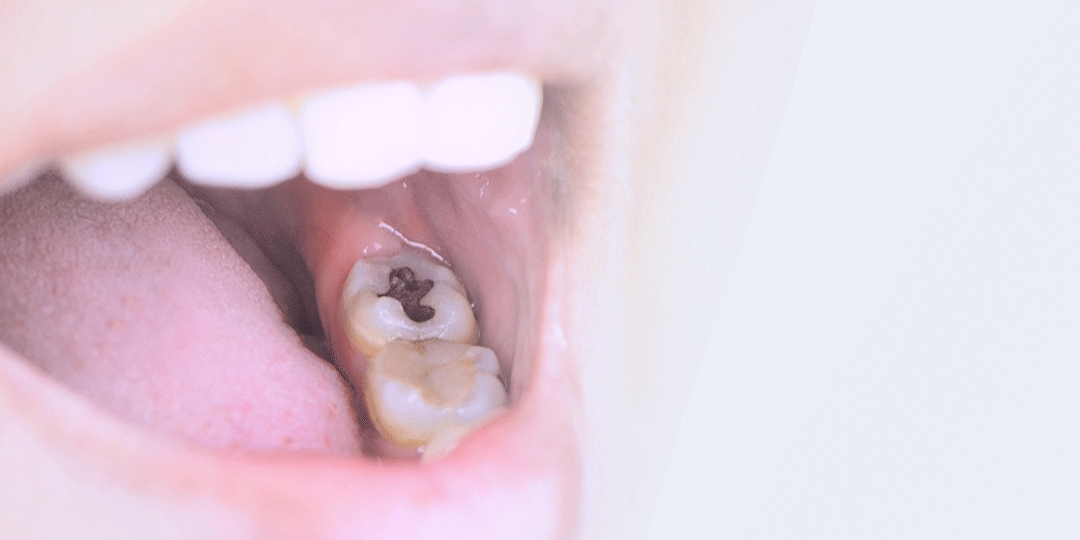 Amálgama dental: entenda por que removê-lo - Centro Conscientia